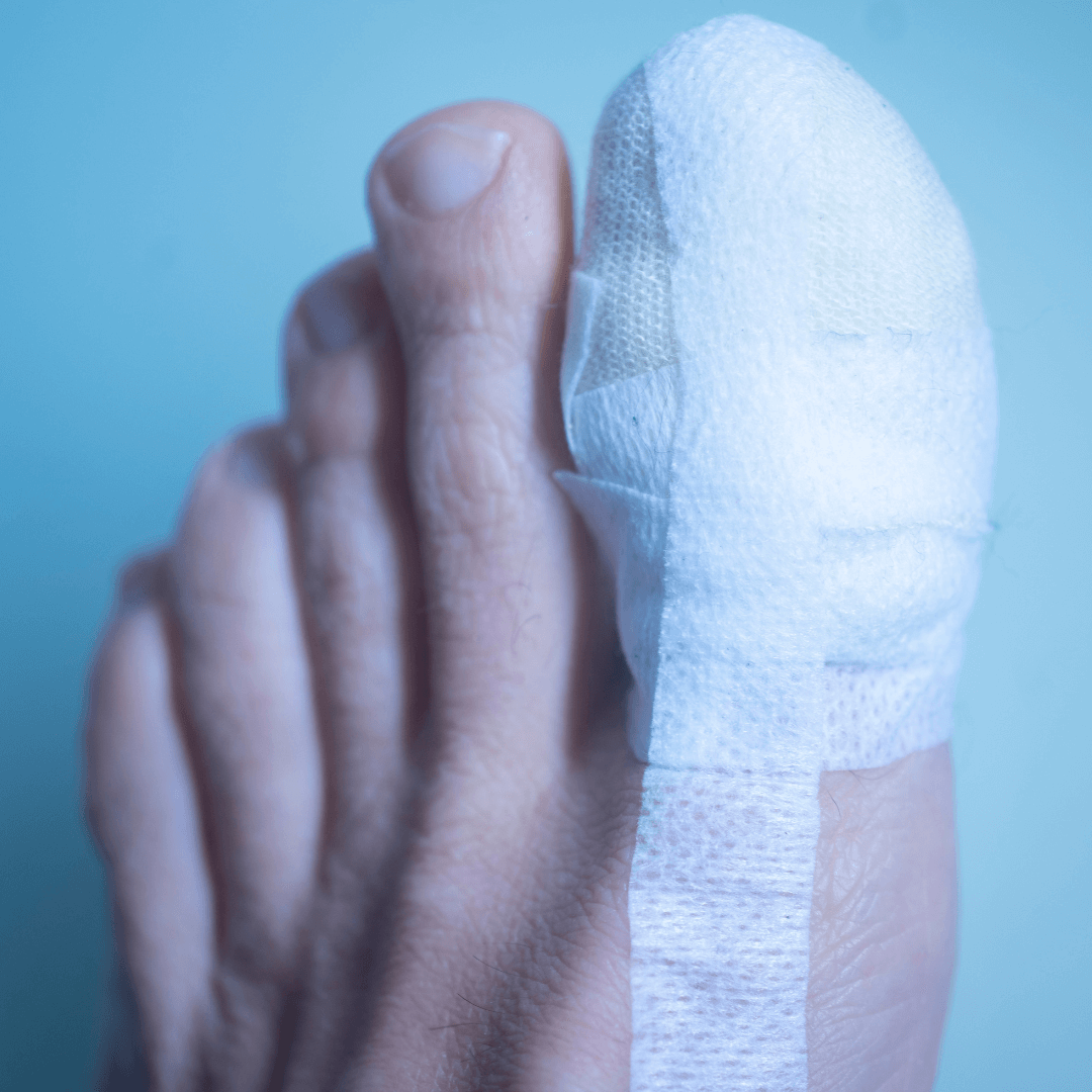 Comment protéger ses orteils au foot : nos conseils pour une protection ...